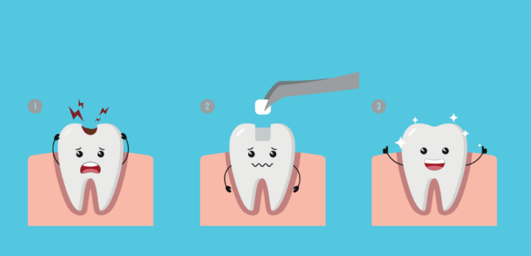 How to Spot a Cavity Between Your Teeth